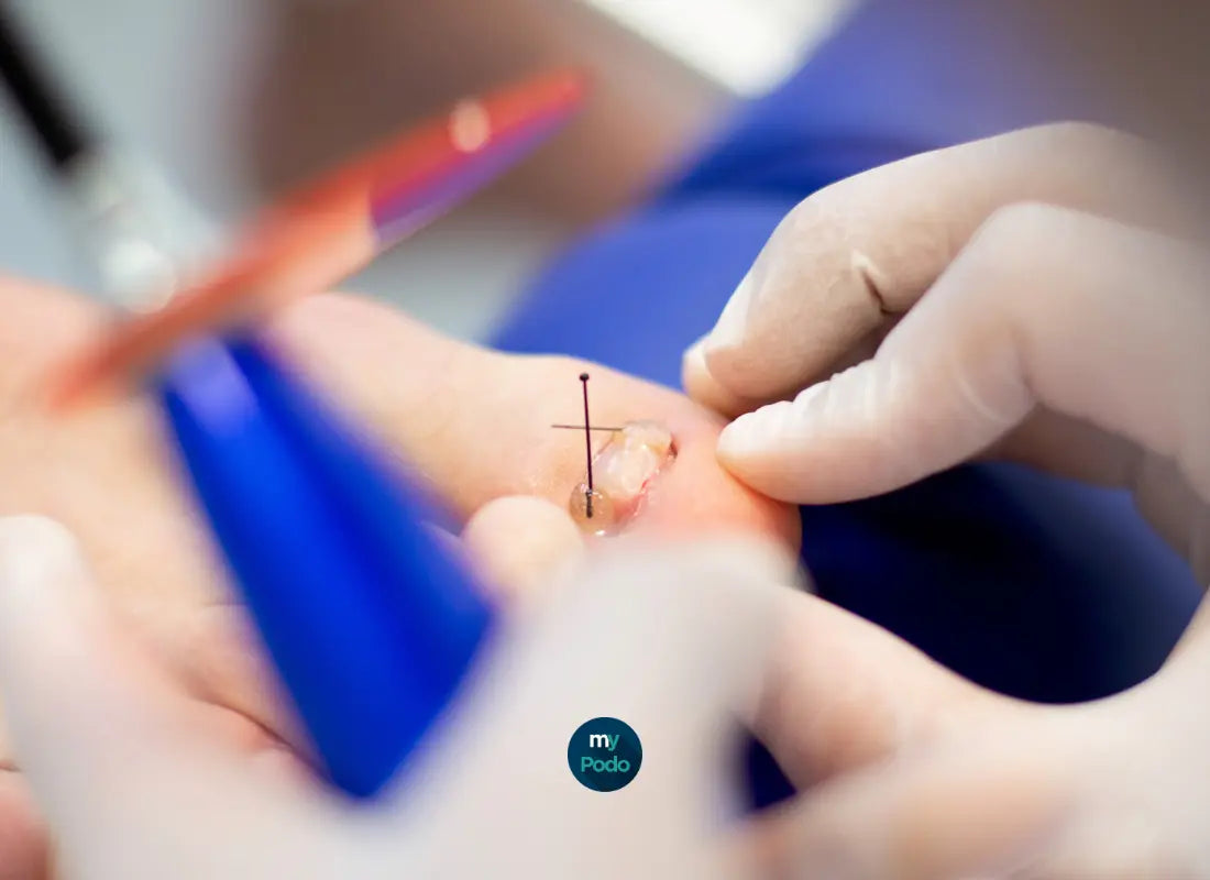 Orthonyxia: the sliding block technique | My Podologie