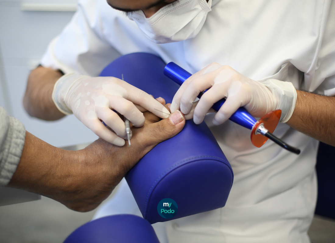 The know-how of the chiropodist-podiatrist in making orthonyxia | My ...